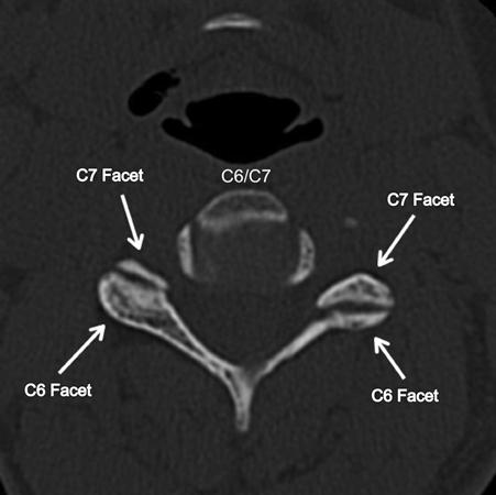 Cervical Facet Dislocations & Fractures - Spine - Orthobullets